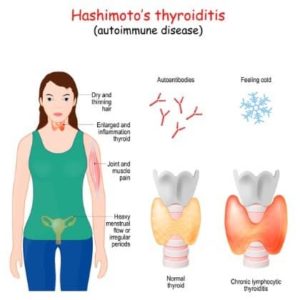 Hashimoto’s Thyroiditis Diagnosis? What You Need to Know – Organixx