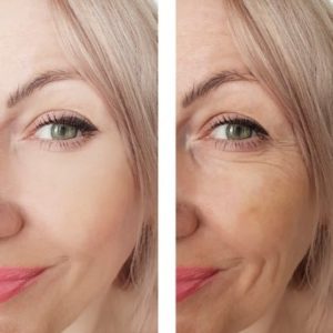 Wrinkles on Face? Matrixyl Morphomics Combats 4 Types of Facial Lines ...